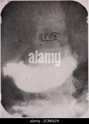 . Journal of radiology . Case 42. No. 4393The illustration is a lateral ...