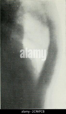 x-rays, pulmonary emphysema Stock Photo - Alamy