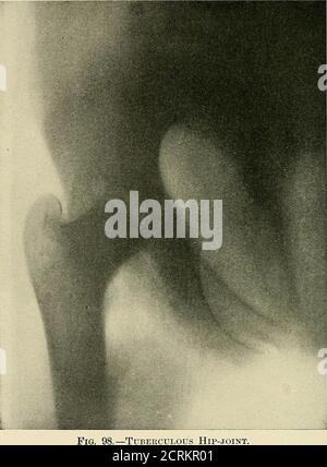 X ray congenital dislocation of hips Stock Photo - Alamy