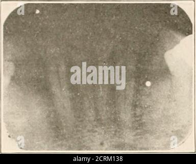 . Interpretation of dental & maxillary roentgenograms . ^m 1 *» H I Fig ...