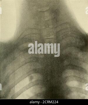 ESOPHAGEAL CARCINOMA, X-RAY Stock Photo - Alamy