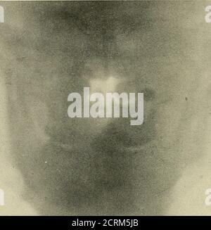 X-ray of the skull bones in lateral projection with upper spine ...