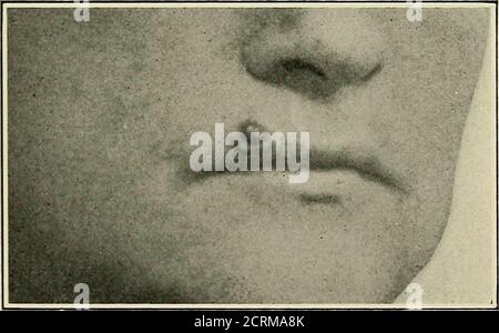 . Radiotherapy and phototherapy : including radium and high-frequency ...