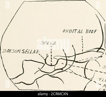 . Roentgen diagnosis of diseases of the head . Fig. 13 ...
