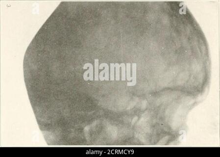 . Roentgen diagnosis of diseases of the head . Fig. 13 ...