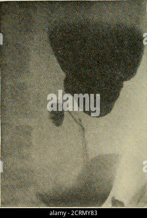 . Radiography and radio-therapeutics . Fig. 299.—Hour-glass contraction ...