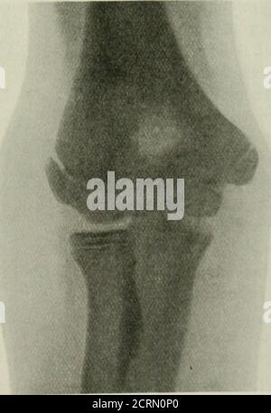 . Radiography and radio-therapeutics . Epiphyseal line Patella Aiitero ...