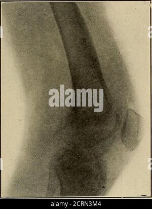 . Diseases of bones and joints . Fig. 41. Hereditary syphilis of the ...