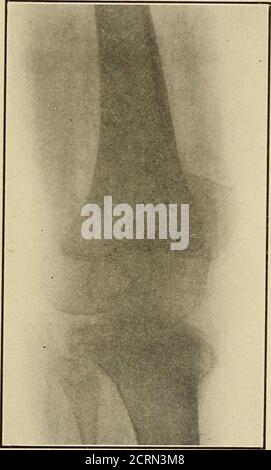 TUBERCULOUS ARTHRITIS, X-RAY Stock Photo - Alamy