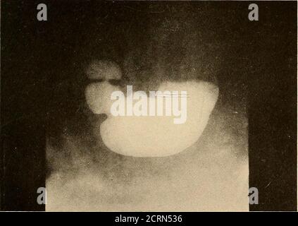 . A manual of X-ray technic . Fig. 31.—Atonic stomach.. Fig. 32 ...