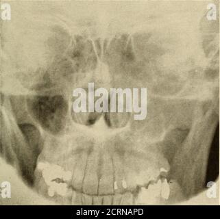 Sinusitis of the right maxillary sinus. The sinus is filled with mucus ...