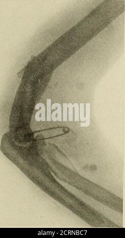 . Radiography and radio-therapeutics . Fig. 216.—Fracture of shaft of ...