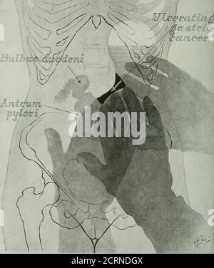 Benign gastric ulcer 3 Stock Photo - Alamy