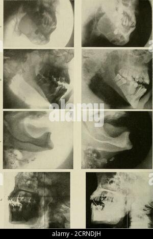 . Radiography and radio-therapeutics . teeth, calcified cervical glands ...