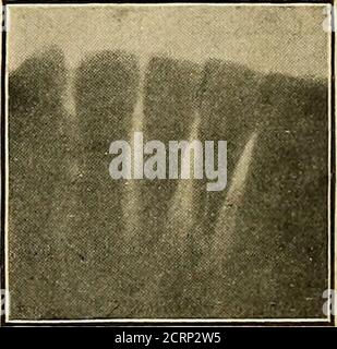 X-ray pictures taken from two different angle's of the break in ...