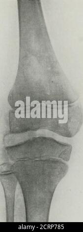 osteoporosis, bone atrophy Stock Photo - Alamy