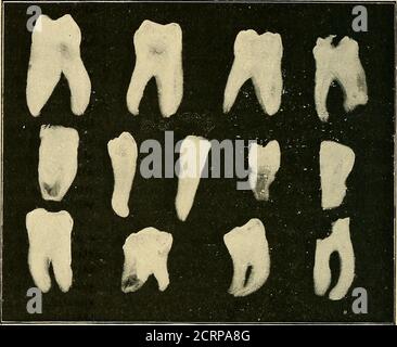 Medical Dental X Rays of Teeth Upper and Lower Mouth Left Side Health ...
