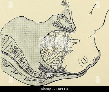 Foetus in breech birth position with umbilical cord around its neck ...