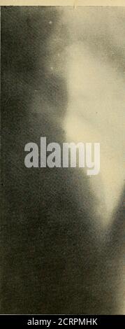 x-rays, pulmonary emphysema Stock Photo - Alamy