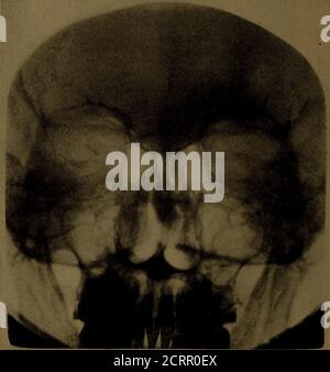 Normal X-ray of Sinuses Stock Photo - Alamy