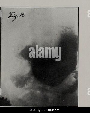 PYLORIC STENOSIS, X-RAY Stock Photo - Alamy