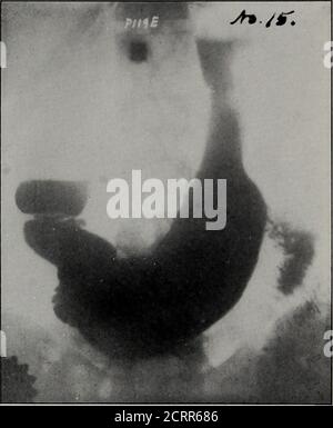 . American quarterly of roentgenology . Fig. 14. Pyloric stenosis, due ...