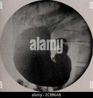 . American quarterly of roentgenology . Fig. 7. Same case, lateral view ...