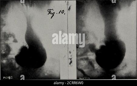 . American quarterly of roentgenology . Fig. 7. Same case, lateral view ...