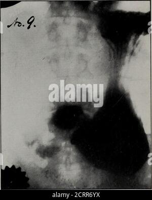 . American quarterly of roentgenology . Fig. 7. Same case, lateral view ...