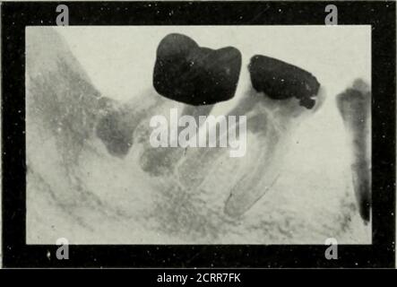 . Elementary and dental radiography . Fig. 245. Two artificial roots ...