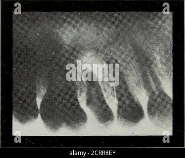 . Elementary and dental radiography . Fig. 214 Fig. 215 Fig. 214 ...