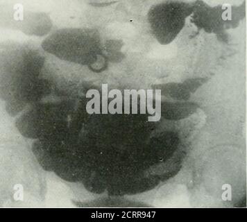 Proximal Vs Distal Colon