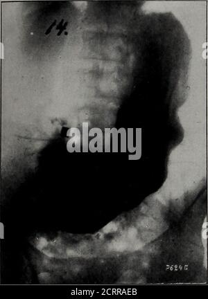 . American quarterly of roentgenology . Fig. 14. Pyloric stenosis, due ...
