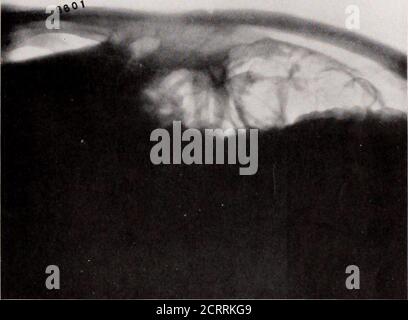 . Journal of radiology . Case 42. No. 4393The illustration is a lateral ...