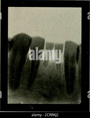 . Elementary and dental radiography . Fig. 137. Fig. 138. Fig. 137. Two ...