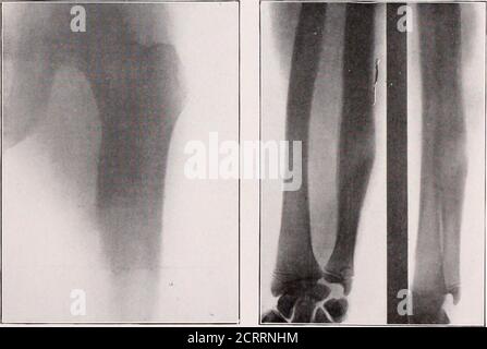 . Journal of radiology . Fig. 79. Path. No. 11769. Syphilitic ...