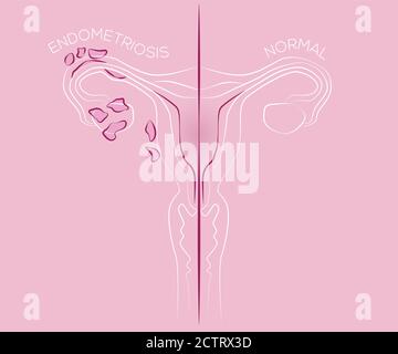 Illustration of endometriosis, endometrial tissue in the uterus, female ...