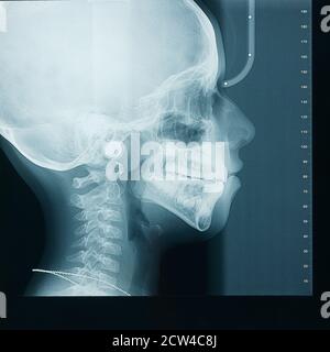 xray of the head of a child or kid side view Stock Photo - Alamy