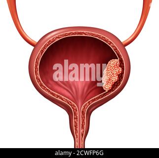 Urinary bladder cancer, illustration Stock Photo - Alamy