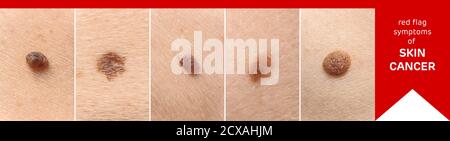 Different types of skin mole closeup. Macro photo of blemish classes ...