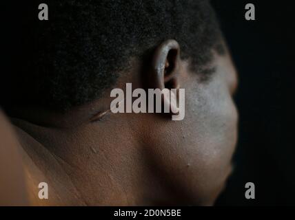Scar left on the neck after a surgical intervention of a cervical disc ...
