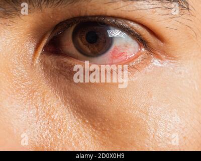 Closeup red blood conjunctivitis eyes of male infected with ...