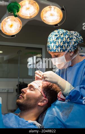 Micrografting hair follicle extraction, FUE Follicular Unit Extraction ...