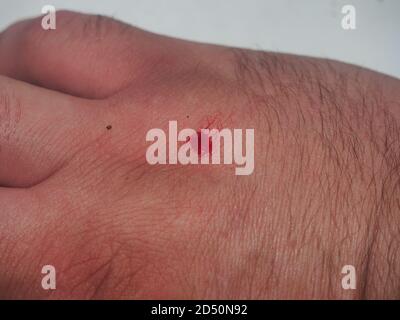 A bleeding scratch on the back of his hand. Small injury. Skin damage ...