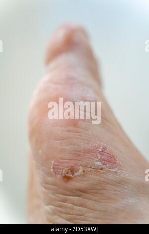 rash-eczema-dermatitis-on-foot-inflammation-of-skin-stock-photo-alamy