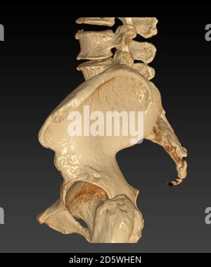 CT Scan of pelvic bone with both hip joint 3D rendering image Inlet ...