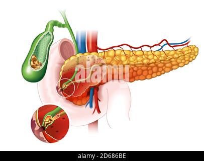 Illustration showing Inflamed pancreas, gallstones blocking bile duct ...