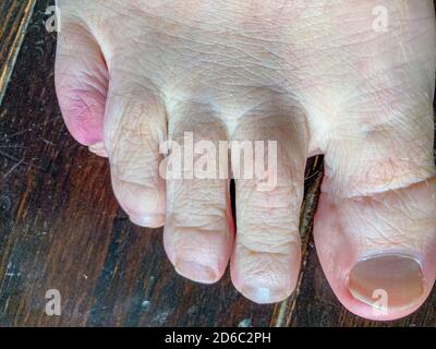 Bruised fractured little toe of a man in close up over a wooden deck as ...