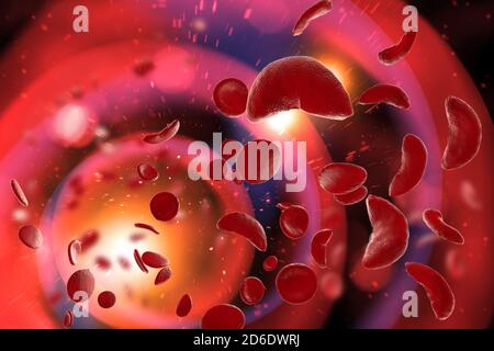 Sickle cell anemia disease (SCD) blood cells 3D illustration Stock ...