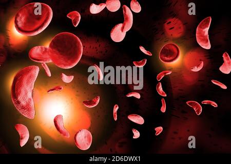 Sickle cell anemia disease (SCD) blood cells 3D illustration Stock ...